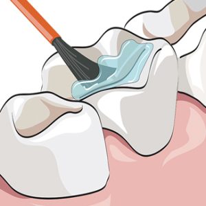 Preventative Care - Westover Dental Clinic